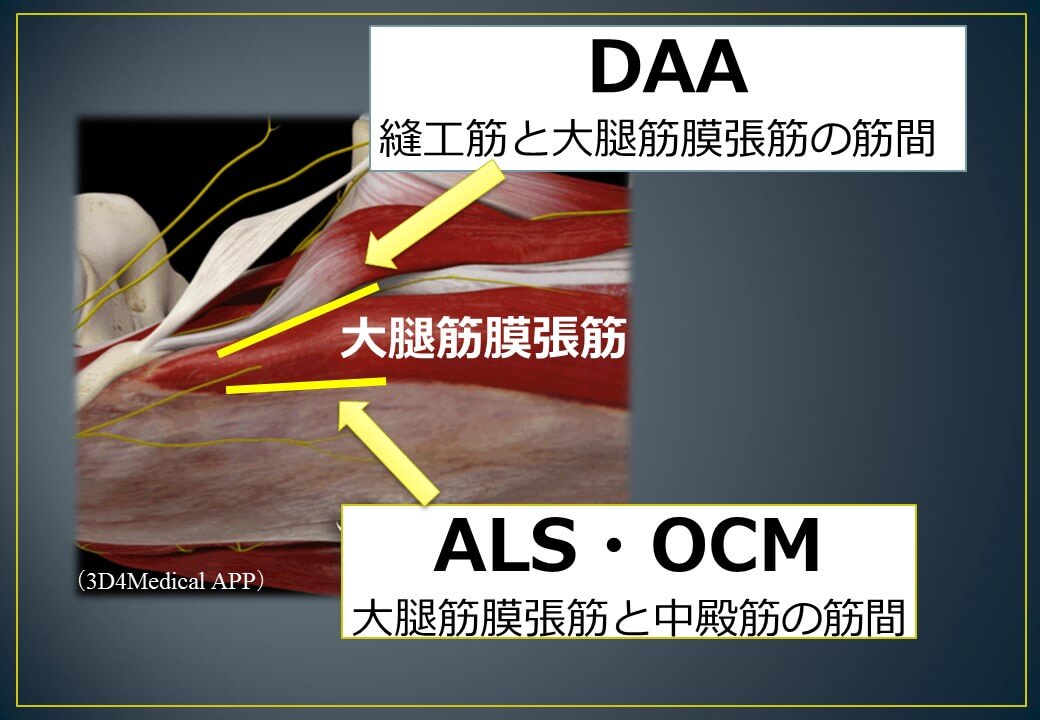 人工股関節全置換術の手術アプローチ | 世田谷人工関節・脊椎クリニック